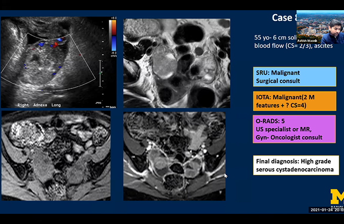 Imaging Based Stratification and Management of Ovarian-Adnexal Lesions